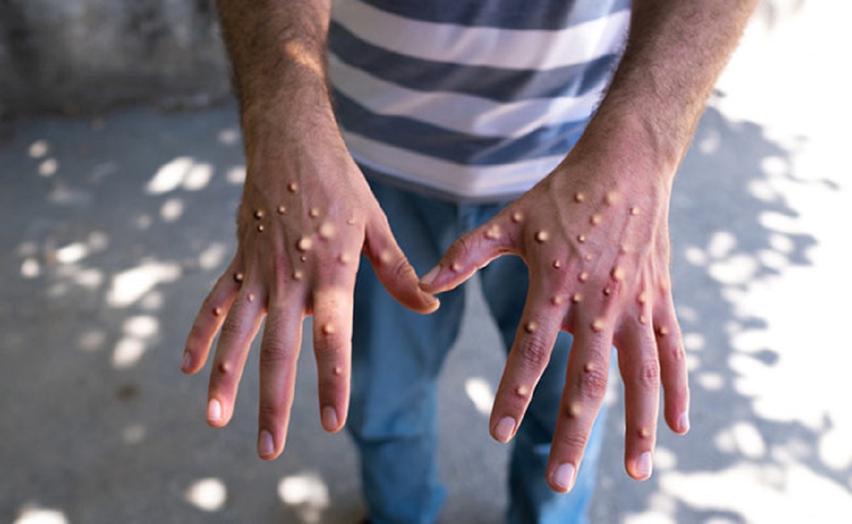 ભારતમાં મંકીપોક્સનો મામલો સામે આવ્યો - A Case Of Monkeypox Came To ...